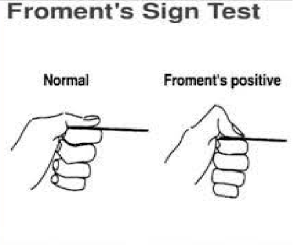 Upper Limb Peripheral Nerve Injury Assessment | Physiolair | All You ...