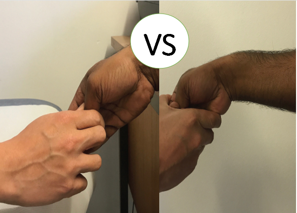 FINKELSTEIN'S VS EICHHOFF'S TEST | Physiolair | All You Need About ...